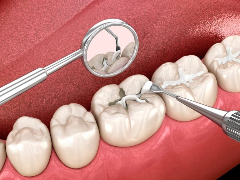 Traditional Fillings vs. Laser Fillings | Durability & Benefits